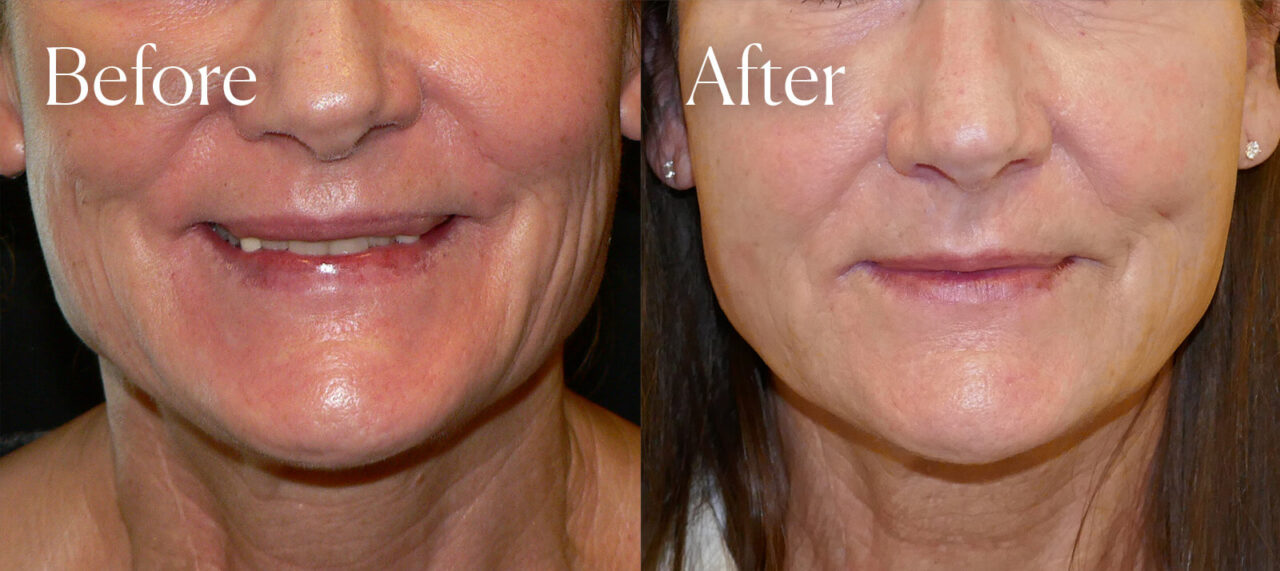 Dimpleplasty Before and After | Denver, CO | Shah Aesthetic Surgery