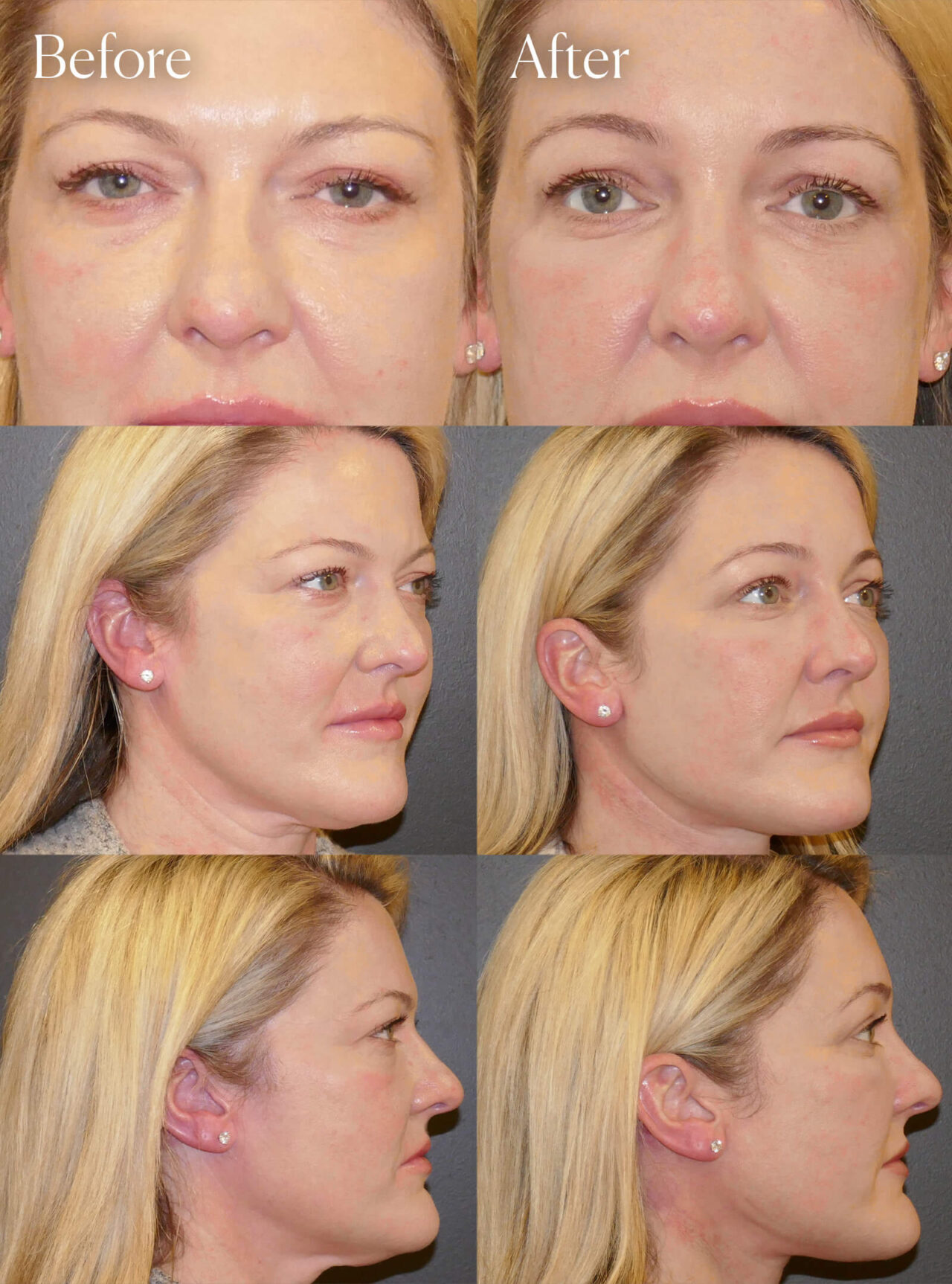 Plastic Surgery Before & After Photos | Denver, CO