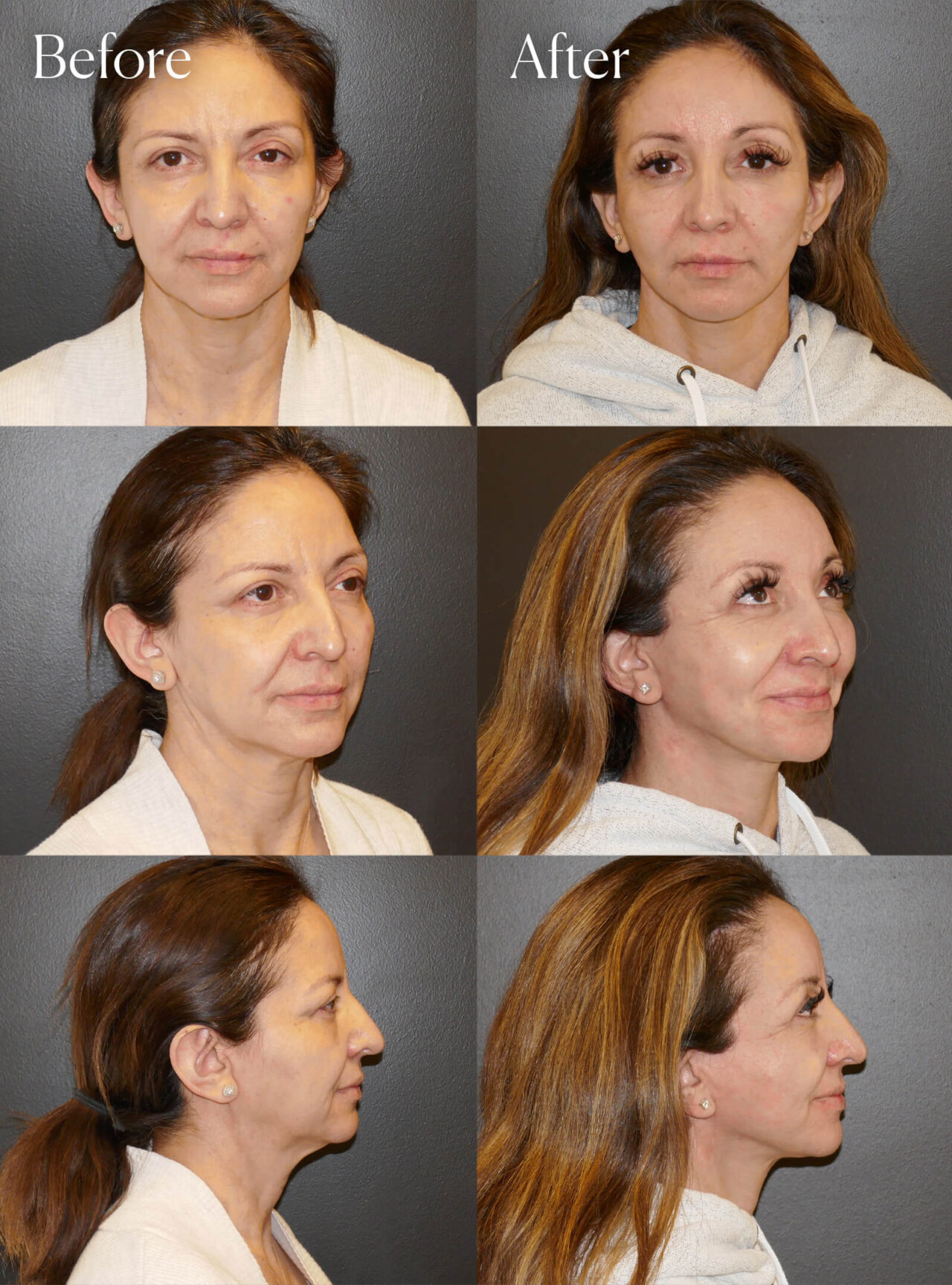 Face Lift Before and After | Denver, CO | Shah Aesthetic Surgery