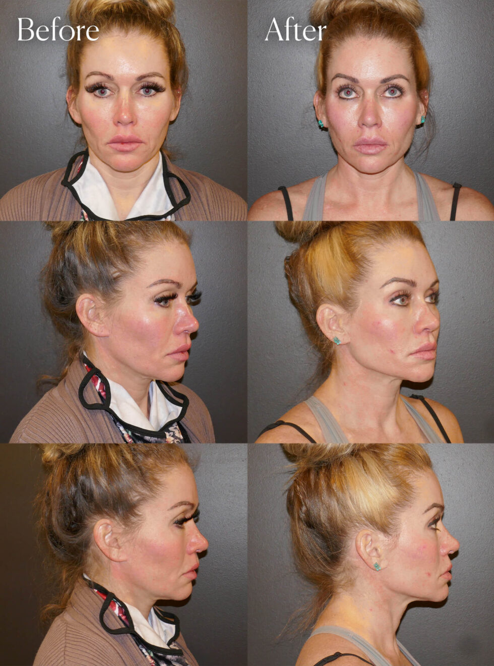 Face Lift Before and After | Denver, CO | Shah Aesthetic Surgery