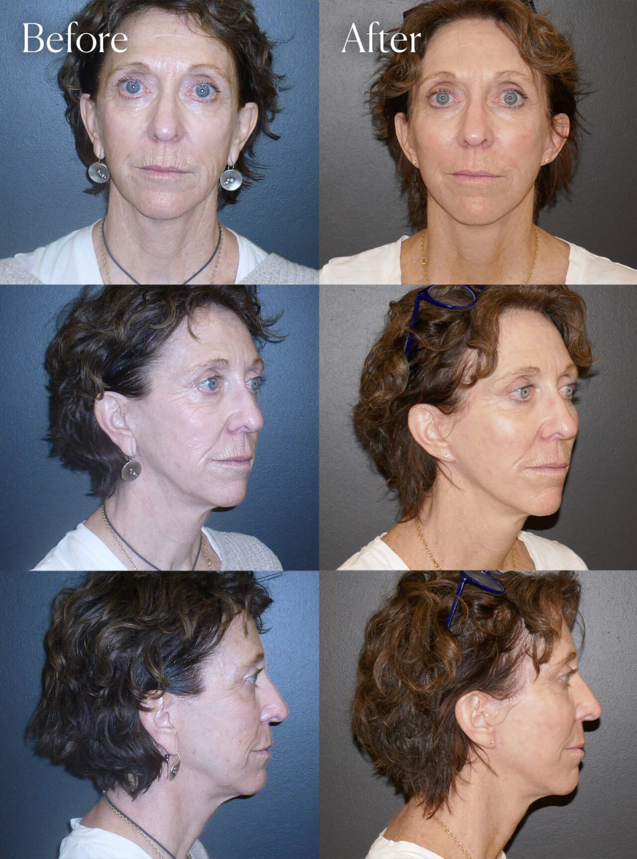 Face Lift Before and After | Denver, CO | Shah Aesthetic Surgery