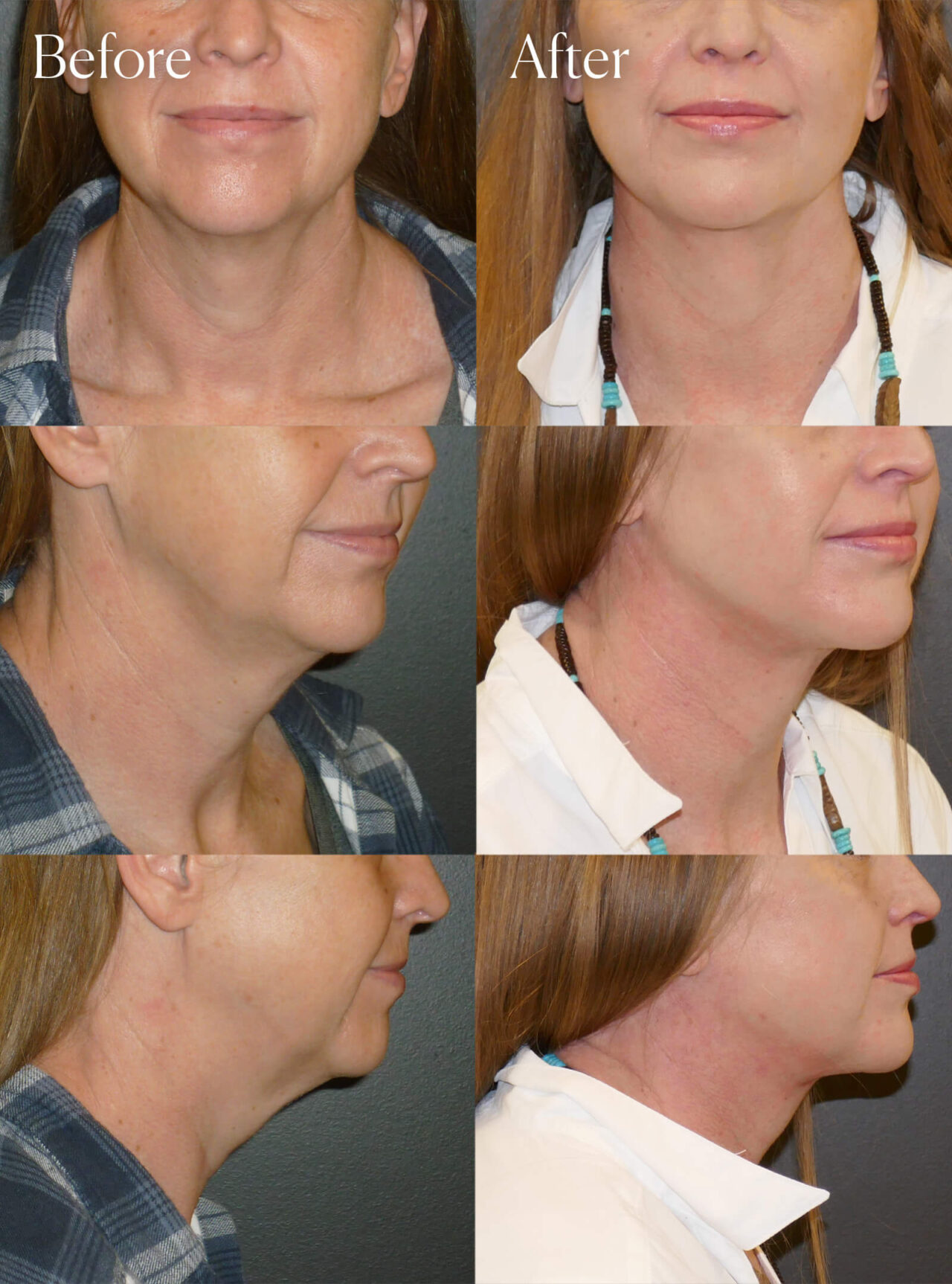 Neck Lift in Englewood, CO | Shah Aesthetic Surgery
