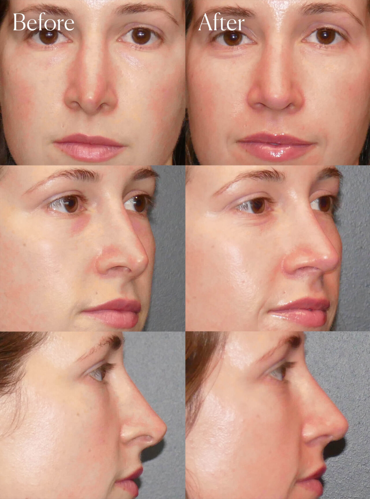 Rhinoplasty Photos | Denver, CO | Shah Aesthetic Surgery