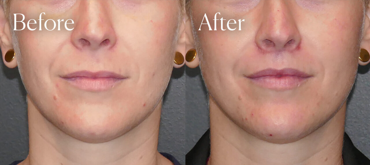 Subnasal Lip Lift Photos | Denver, CO | Shah Aesthetic Surgery