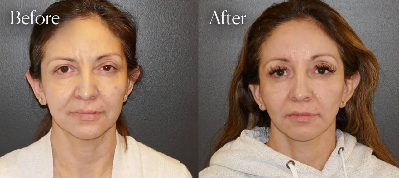 Facial Plastic Surgeon in Denver, CO | Shah Aesthetic Surgery