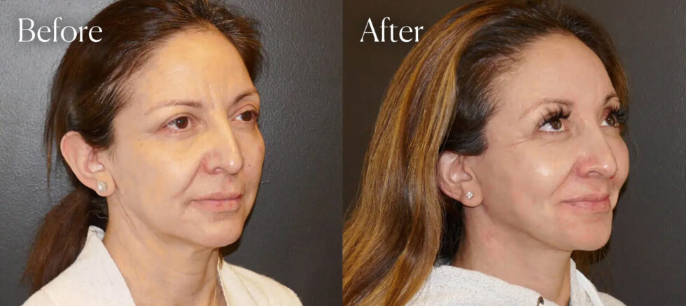 Facial Plastic Surgeon in Denver, CO | Shah Aesthetic Surgery