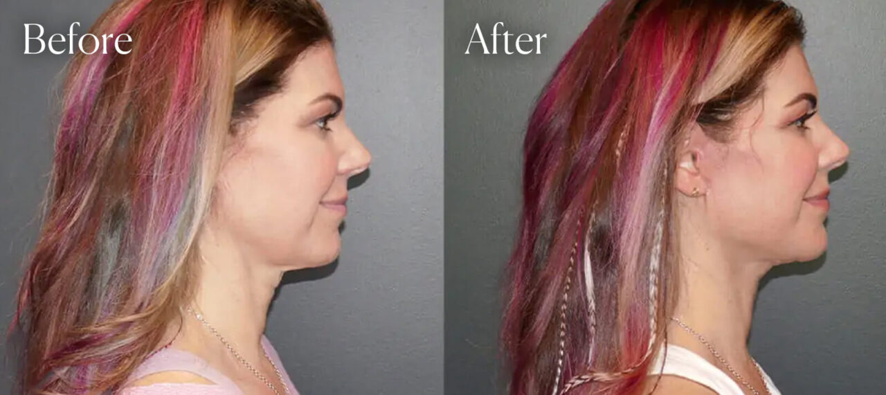 Facial Plastic Surgeon in Denver, CO | Shah Aesthetic Surgery