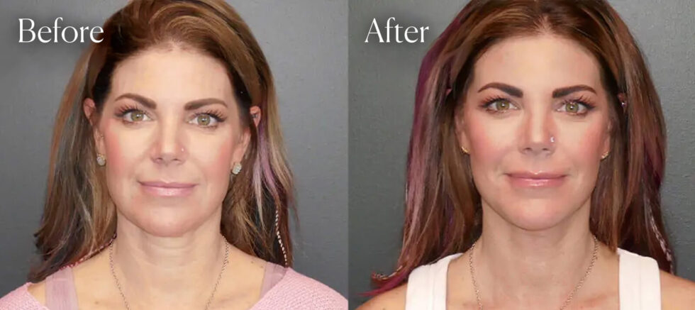Facial Plastic Surgeon in Denver, CO | Shah Aesthetic Surgery
